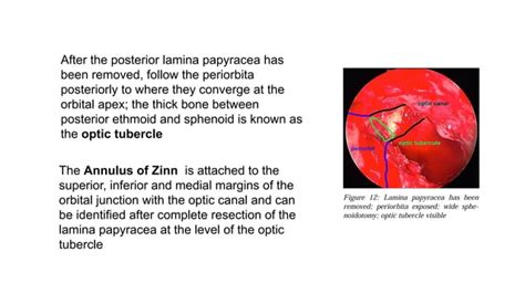 Optic Nerve Decompression With Optic Nerve Pdf