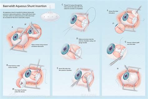 Baerveldt Aqueous Shunt Insertion Ami 2019
