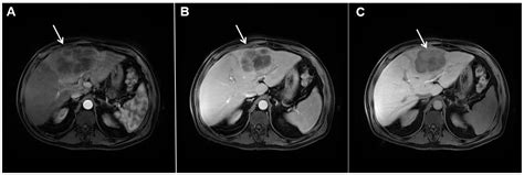 Current Oncology Free Full Text Imaging Spectrum Of Intrahepatic Mass Forming