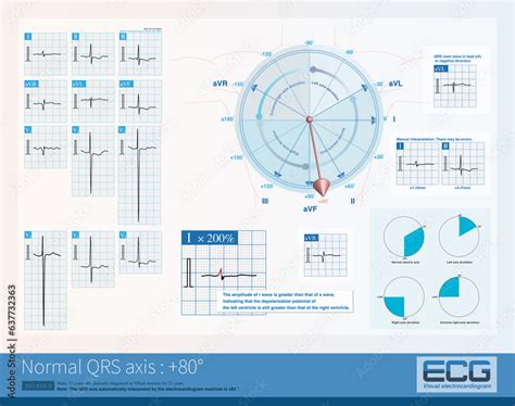 When The Frontal QRS Axis Is At The QRS Amplitude Of Lead AVF Is The Highest The Frontal