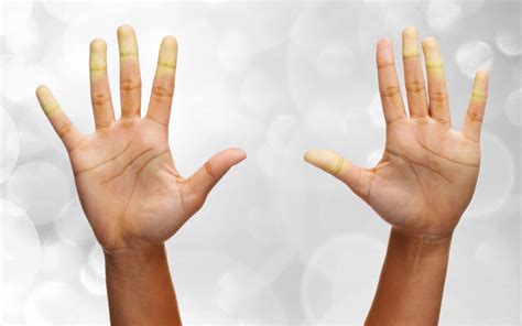 When Skin Speaks Understanding Scleroderma Rheumatology Plus