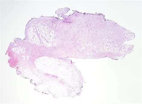 Nodular Fasciitis Dermatopathology