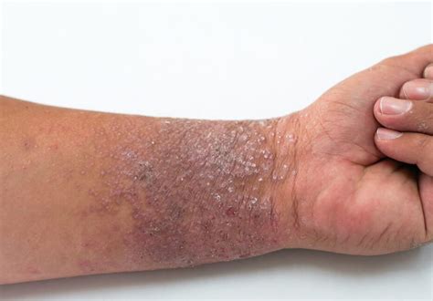 What Is Eczema What Treatments Are Available Apax Medical Clinic