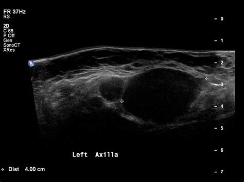 Axillary Lymphadenopathy
