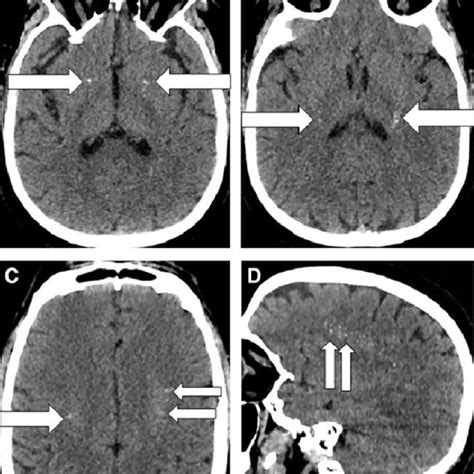 Brain Ct Scan Showed Bilateral Asymmetrical Punctate Calcifications In