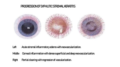 Interstitial Keratitis Powerpoint Presentation Pptx Interstitial Keratitis Powerpoint Presentation Pptx