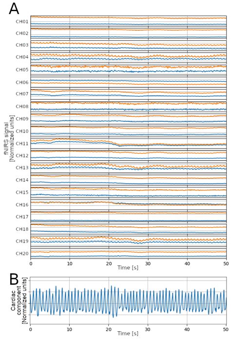 Sensors Free Full Text Performance Assessment Of Heartbeat Detection Algorithms On