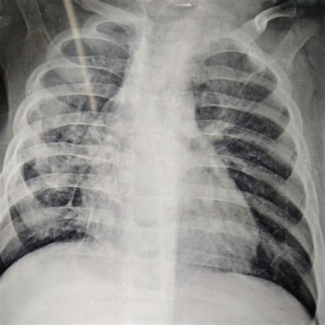 Antibiotic Sensitivity Patterns Of Gram Negative Bacteria That Cause Download Scientific