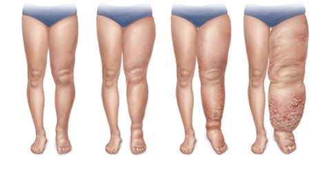 Lymphedema Leg