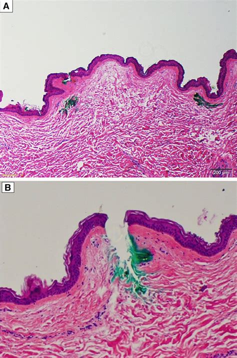 Histology Of Hypertrophic Scar After The Removal Of Dmns Dissolving Download Scientific