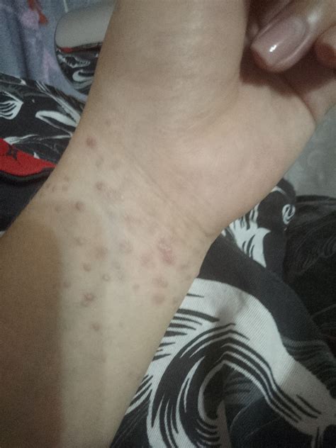 Сыпь что это такое и что нужно делать Сыпь на руках с чем это может Medaboutme