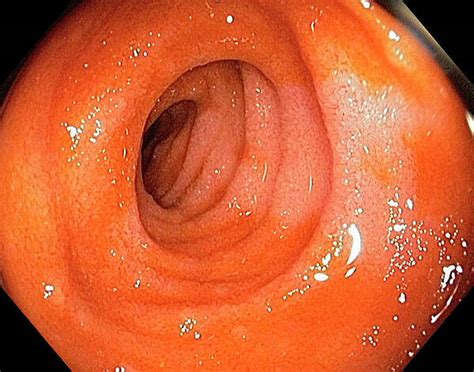 Normal Terminal Ileum Art Print By Science Photo Library Science Photo Gallery