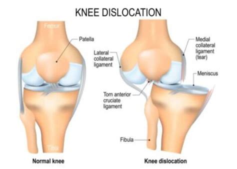 Knee Dislocation Reduction