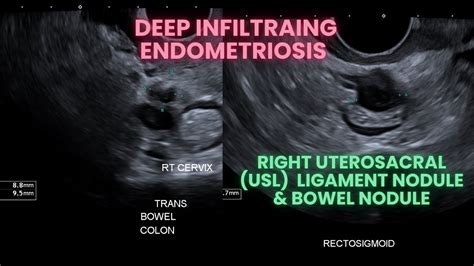 Ultrasound Deep Infiltrating Endometriosis Bowel Nodule And