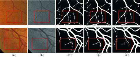 Comparison Of Segmentation Results On Drive A Original Image Patch