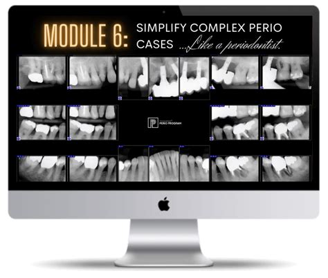 Perio Program Sales Page Surgical Master