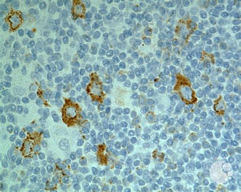 Nlphl With Progression