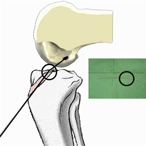 The Starting Point Of The Tibial Tunnel Black Arrow In The Left Knee The Starting Point Of The Tibial Tunnel Black Arrow In The Left Knee