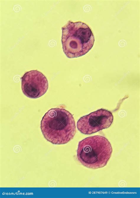 Crytpococcus Neoformans Encapsulated Organism Inside Macrophage Csf Smear Stock Image Image Crytpococcus Neoformans Encapsulated Organism Inside Macrophage Csf Smear Stock Image Image
