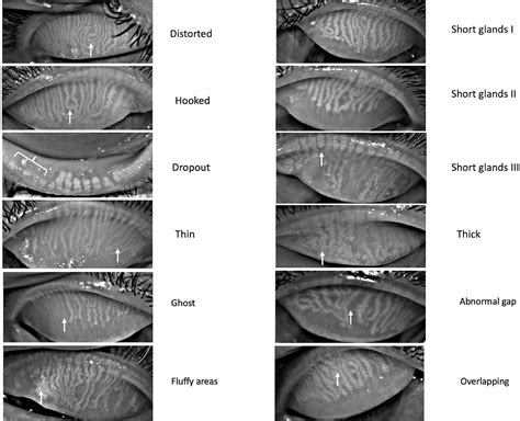 Normal Meibomian Gland