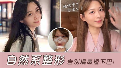 整完一個月｜隆鼻墊下巴｜術前術後分享 隆鼻手術 自然 保有個人特色 Youtube