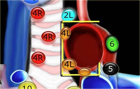 The Radiology Assistant Mediastinal Lymph Node Map