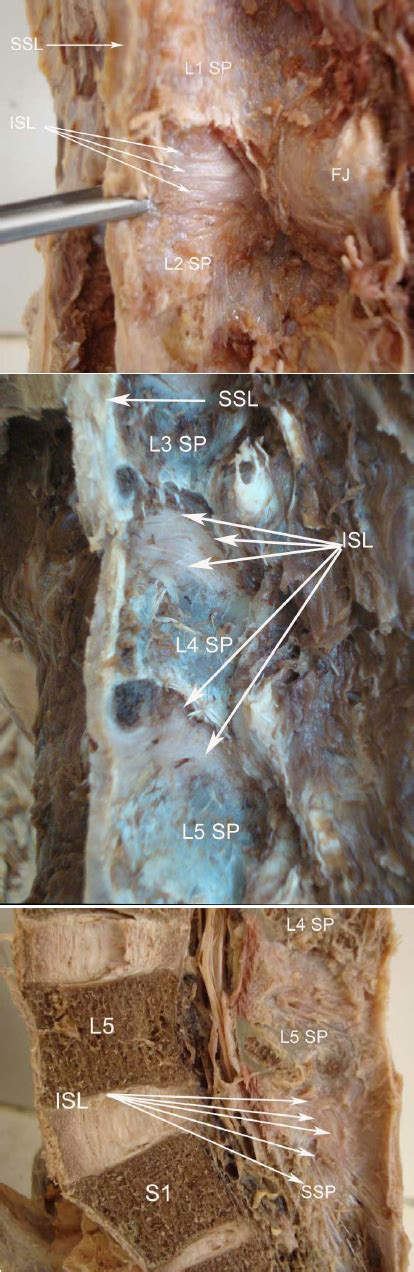 Supraspinous Ligament Cadaver