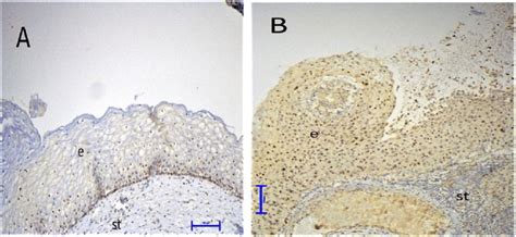 Differential Expression Of P16 In Cervical Tissues By Download