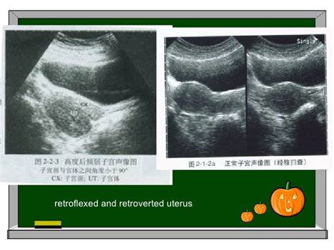 Retroverted Retroflexed Uterus Retroflexed Vs