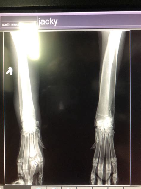 Ali Raza On Linkedin Case File Jackeys Metacarpal Mystery Patient Profile Name Jackey…