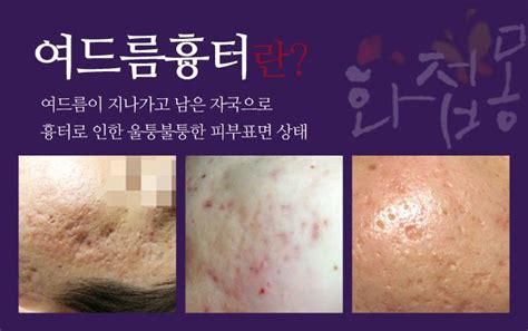 여드름흉터 종류 여드름흉터를 여드름 여드름흉터 모공각화증 치료 화접몽한의원