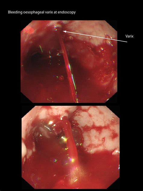 Bleeding Oesophageal Varix Pdf