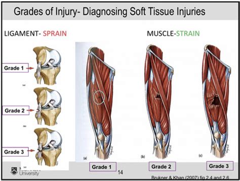 Principles Of Soft Tissue Healing Flashcards Quizlet