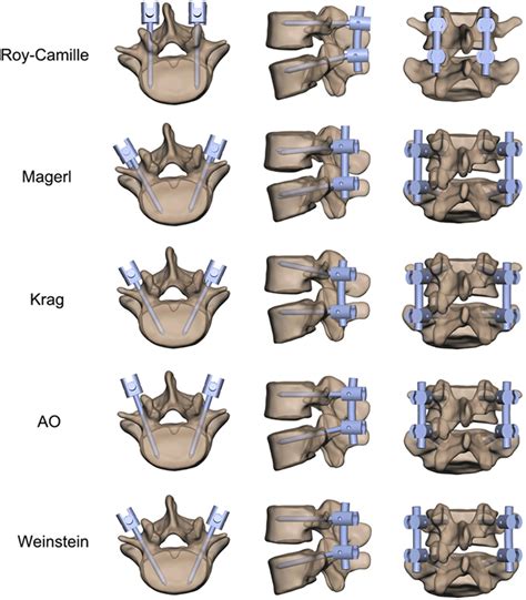 The Methods Of Five Pedicle Screw Insertion Techniques From Top To