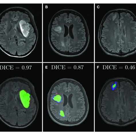 Pdf Data Augmentation For Brain Tumor Segmentation A Review