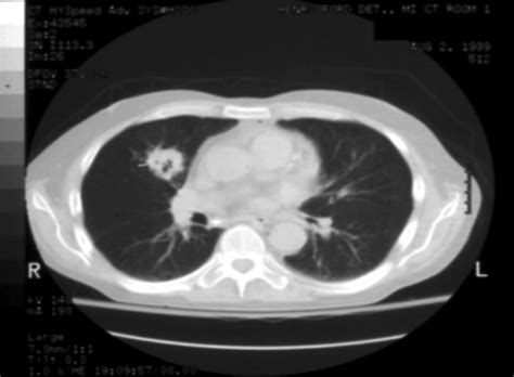 Computed Tomography Scan Showing Cavitary Pulmonary Nodule In The Right Download Scientific