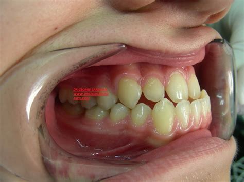 Dr George E Bardawil Orthodontist Invisalign Diamond Level Non Surgical Treatment Class Iii