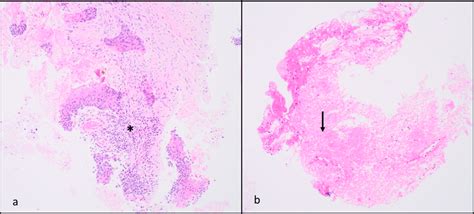 Figure 1 From Dual Layer Spectral Ct As Innovative Imaging Guidance In Lung Biopsies Could