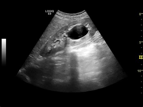 Hypoechoic Normal Renal Sinus And Renal Pelvis Tumors