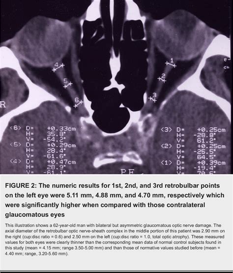 Table 1 From Computed Tomographic Thickness Of Retrobulbar Optic Nerve