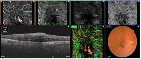Baseline Visit Deep Capillary Plexus Outer Retina And Download