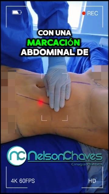 ¡luce Un Abdomen Marcado Y Definido Con Nuestra Marcación Abdominal