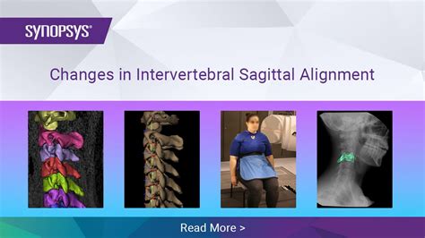 Synopsys Simpleware Software On Linkedin Lumbarspine Finiteelement 3dimageprocessing…