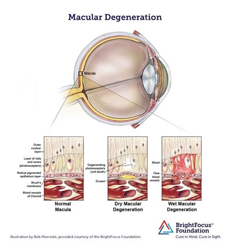 Macular Degeneration Treatment In India Artofit