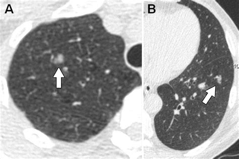 Differentiating Between Subsolid And Solid Pulmonary Nodules At Ct