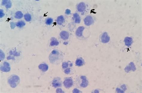 Proliferation Of Lymphocytes And Degenerative Neutrophils With Presence