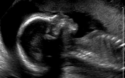 2nd3rd Trimester Fetal Ultrasound Basics — Radiology Slides