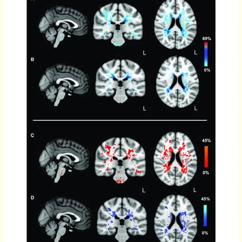 Mapping Of Multiple Sclerosis Lesion Distribution Multiple Sclerosis
