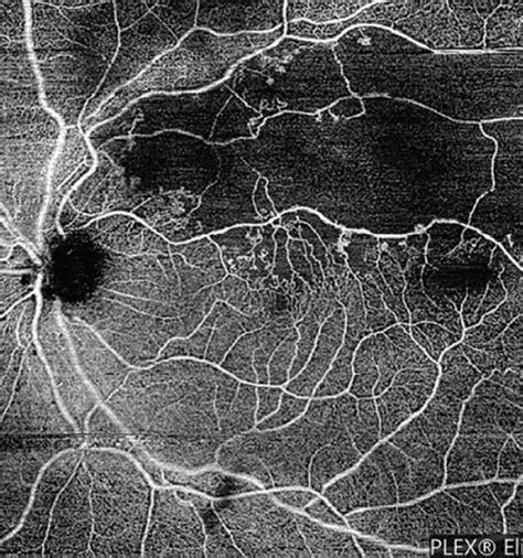 clinical utility of oct angiography for retinal and choroidal vascular