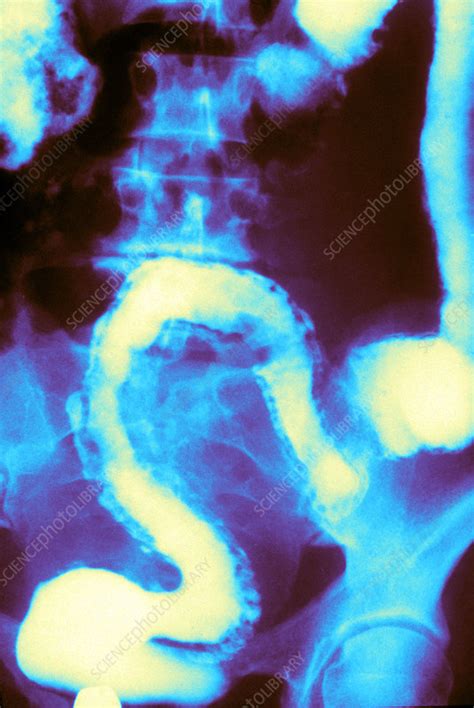 Ulcerative Colitis X Ray Stock Image C0252776 Science Photo